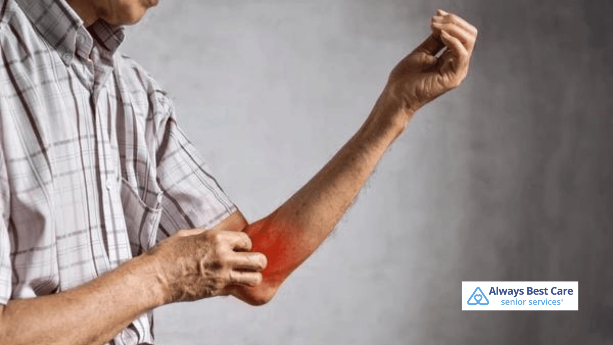 Managing Psoriasis Flare-Ups: Tips For Seniors