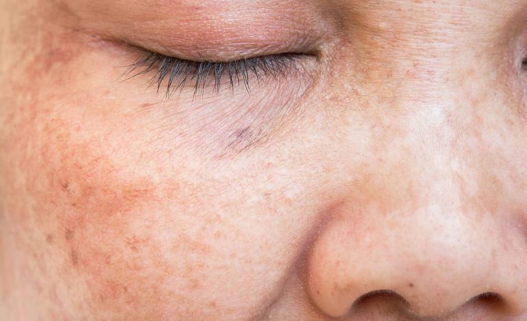 Common Skin Issues In The Elderly + Top Skin Care Tips